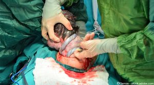 Geburtstrauma: Ursachen, Auswirkungen und Bewältigung